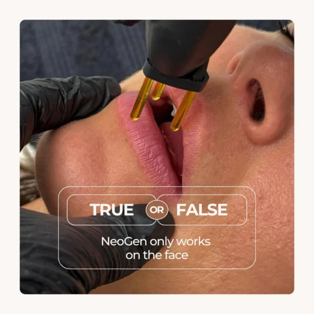 Nitrogen Plasma Skin Regeneration | NeoGen UK