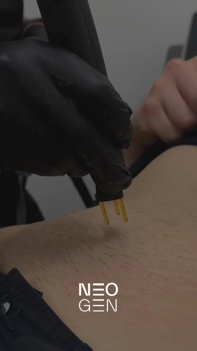 Nitrogen Plasma Skin Regeneration | NeoGen UK